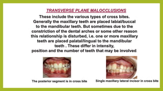 Malocclusion of teeth | PPTX