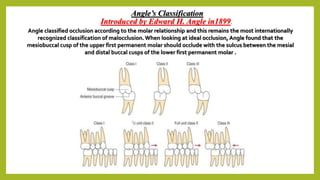 Malocclusion of teeth | PPTX