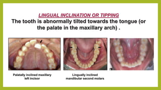 Malocclusion of teeth | PPT