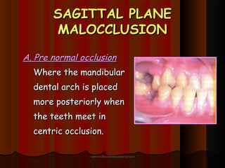 Malocclusion /certified fixed orthodontic courses by Indian dental ...