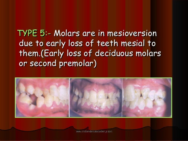Malocclusion /certified fixed orthodontic courses by Indian dental…
