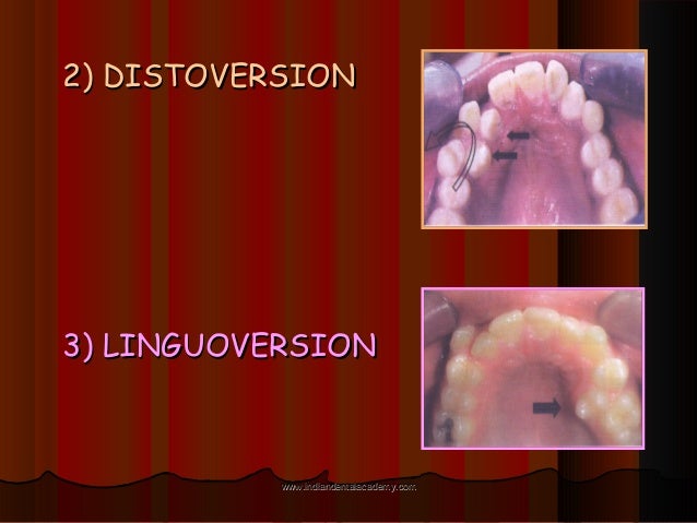 Malocclusion /certified fixed orthodontic courses by Indian dental…