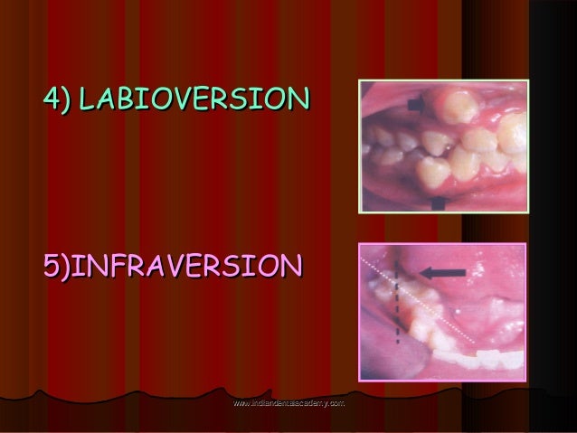 Malocclusion /certified fixed orthodontic courses by Indian dental…