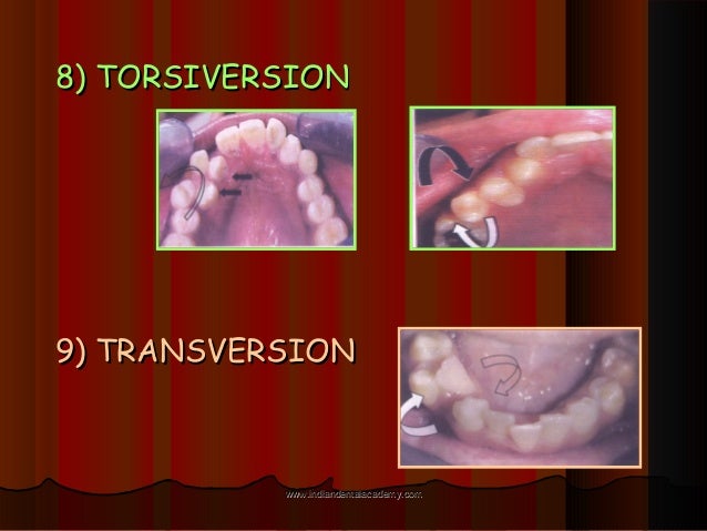 Malocclusion /certified fixed orthodontic courses by Indian dental…