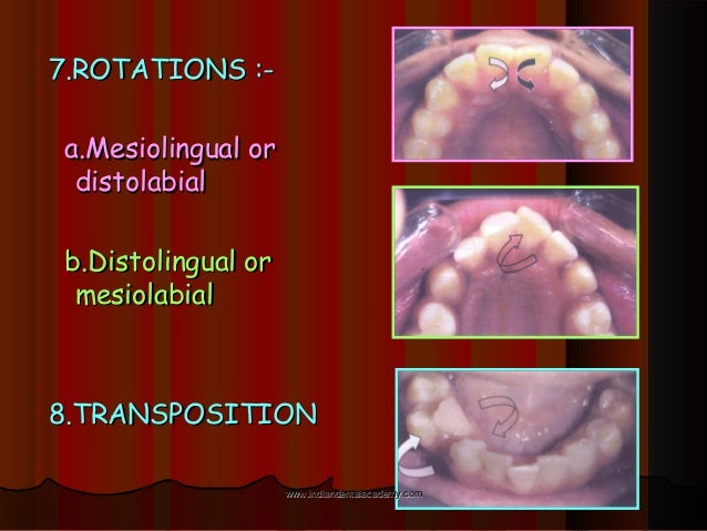 Malocclusion /certified fixed orthodontic courses by Indian dental…