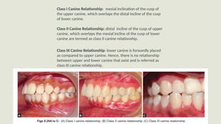 Classification of Dental Malocclusion | PPTX