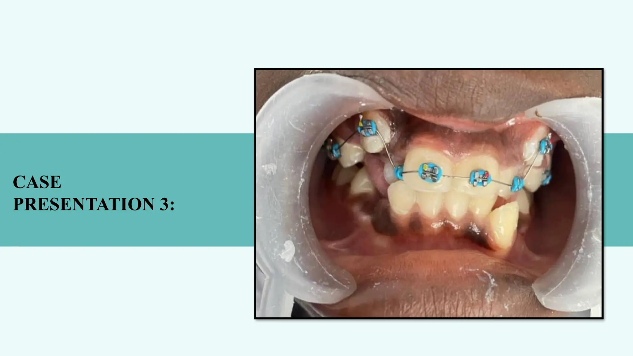 Malocclusion Presentation, general overview | PPTX