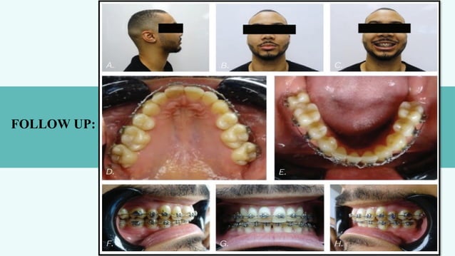 Malocclusion Presentation, general overview | PPTX