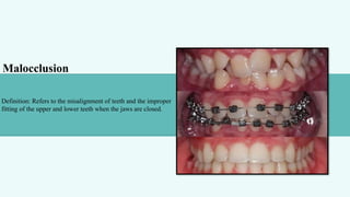 Malocclusion Presentation, general overview | PPTX