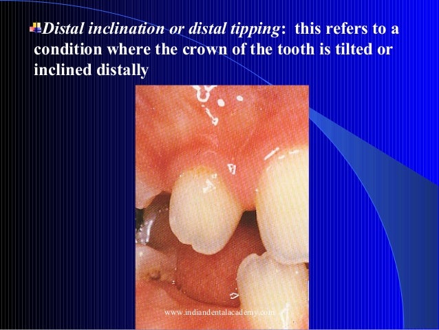 Malocclusion classification /certified fixed orthodontic courses