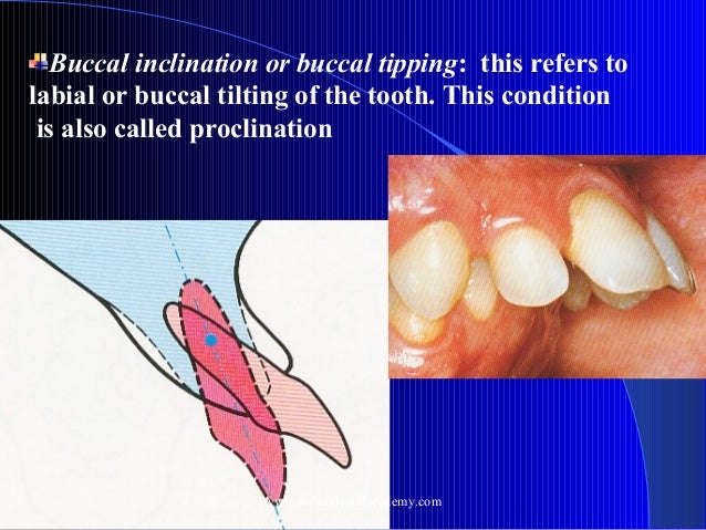 Malocclusion classification /certified fixed orthodontic courses