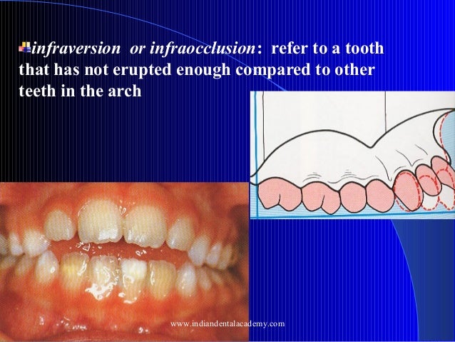 Malocclusion classification /certified fixed orthodontic courses