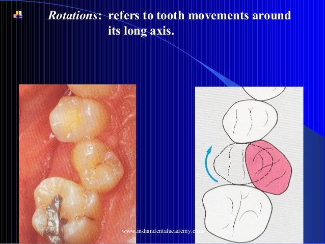 Malocclusion classification /certified fixed orthodontic courses