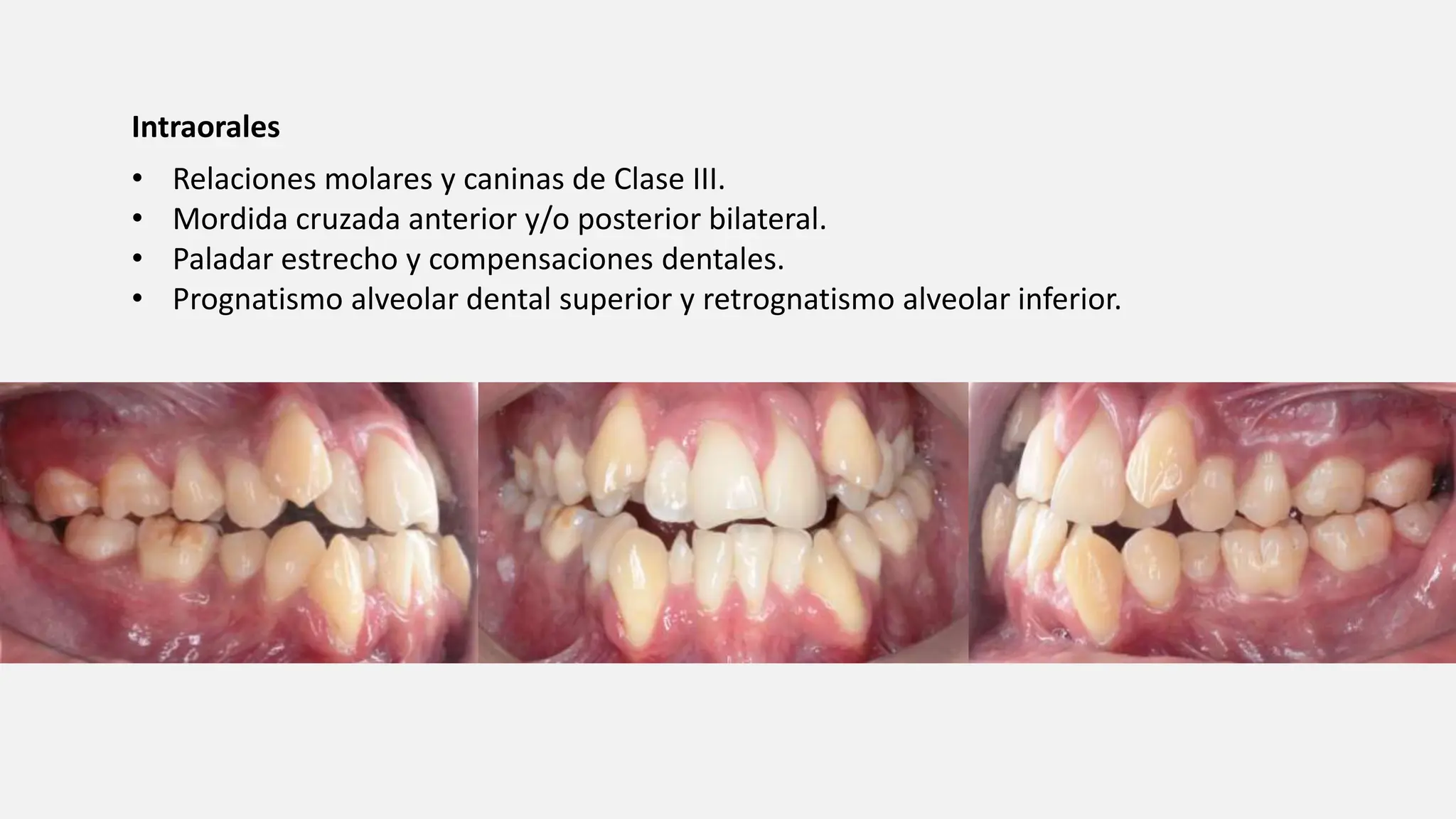Maloclusión clase 3 dental y esqueletal en ortodoncia. | PPTX