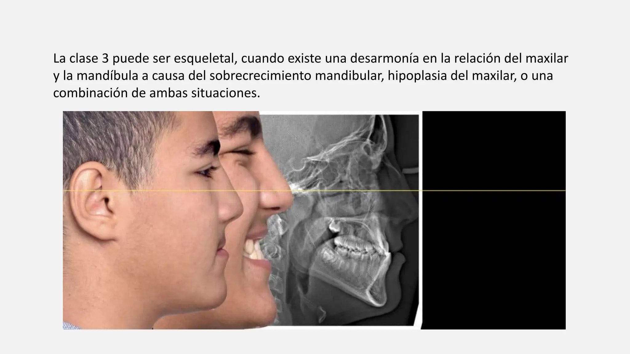Maloclusión clase 3 dental y esqueletal en ortodoncia. | PPTX
