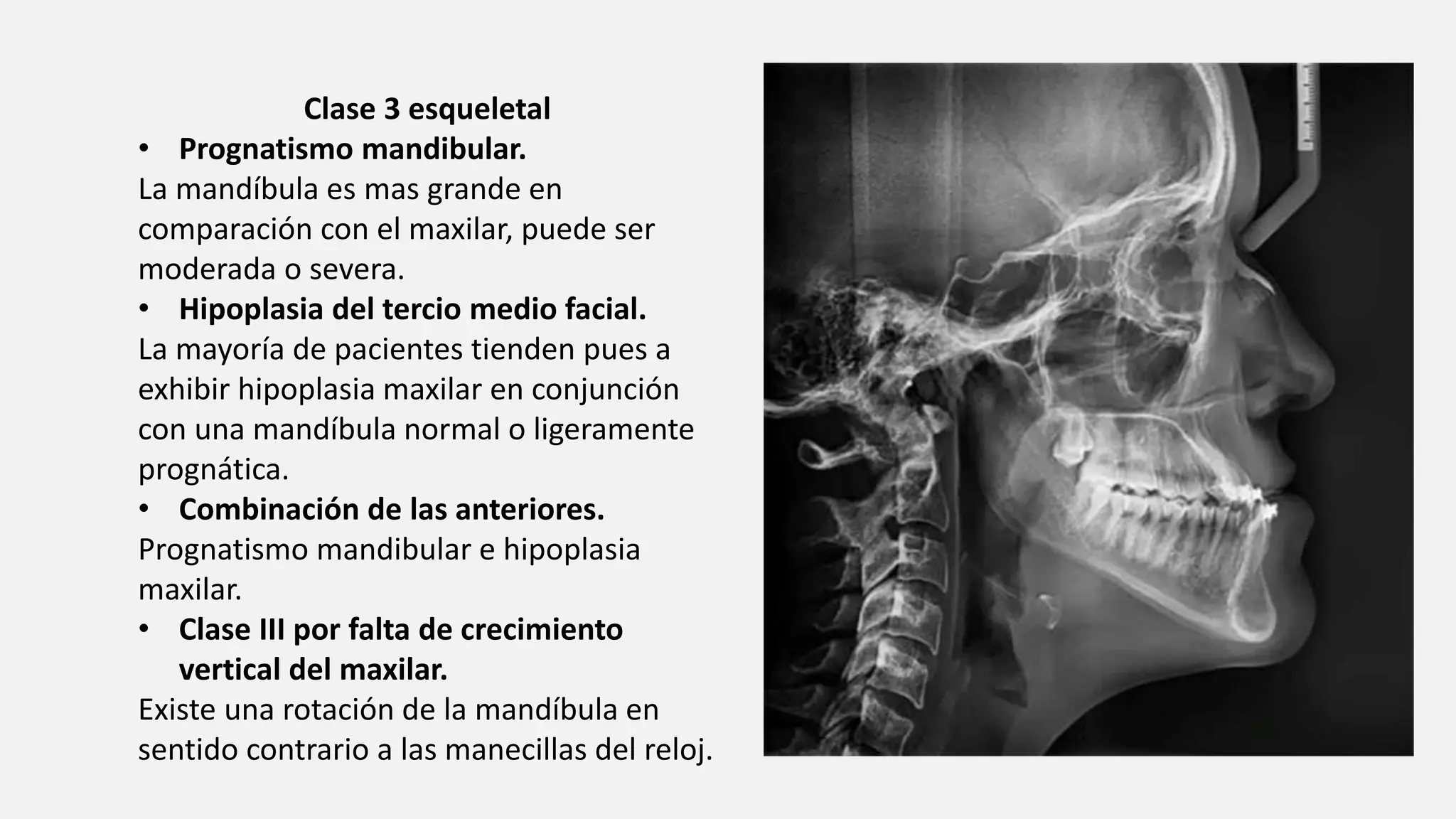 Maloclusión clase 3 dental y esqueletal en ortodoncia. | PPTX