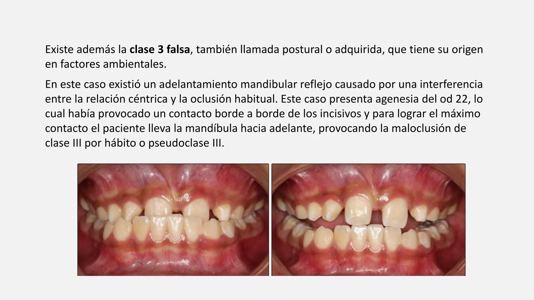 Maloclusión clase 3 dental y esqueletal en ortodoncia. | PPTX