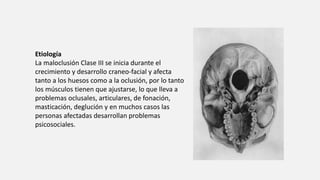 Maloclusión clase 3 dental y esqueletal en ortodoncia. | PPTX