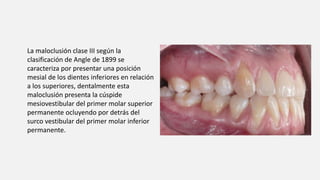 Maloclusión clase 3 dental y esqueletal en ortodoncia. | PPTX