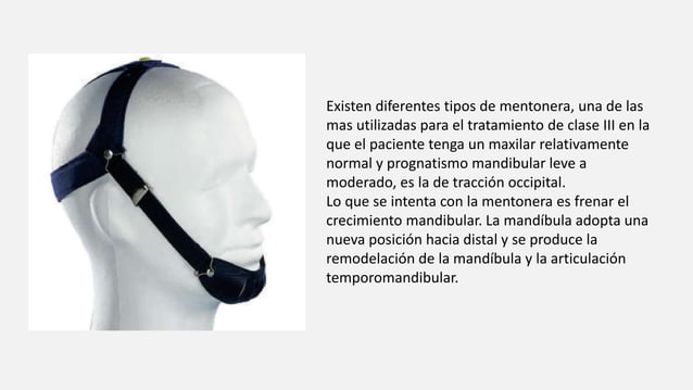 Maloclusión clase 3 dental y esqueletal en ortodoncia. | PPTX