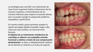 Maloclusión clase 3 dental y esqueletal en ortodoncia. | PPTX