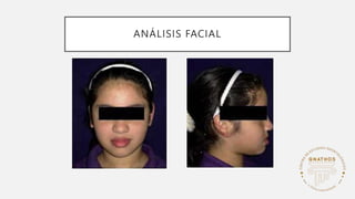 Maloclusión clase 3 dental y esqueletal en ortodoncia. | PPTX