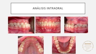 Maloclusión clase 3 dental y esqueletal en ortodoncia. | PPTX