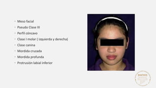 Maloclusión clase 3 dental y esqueletal en ortodoncia. | PPTX