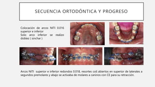 Maloclusión clase 3 dental y esqueletal en ortodoncia. | PPTX