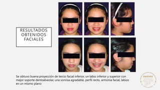 Maloclusión clase 3 dental y esqueletal en ortodoncia. | PPTX