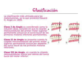 Maloclusion clase ii div i blog | PPT