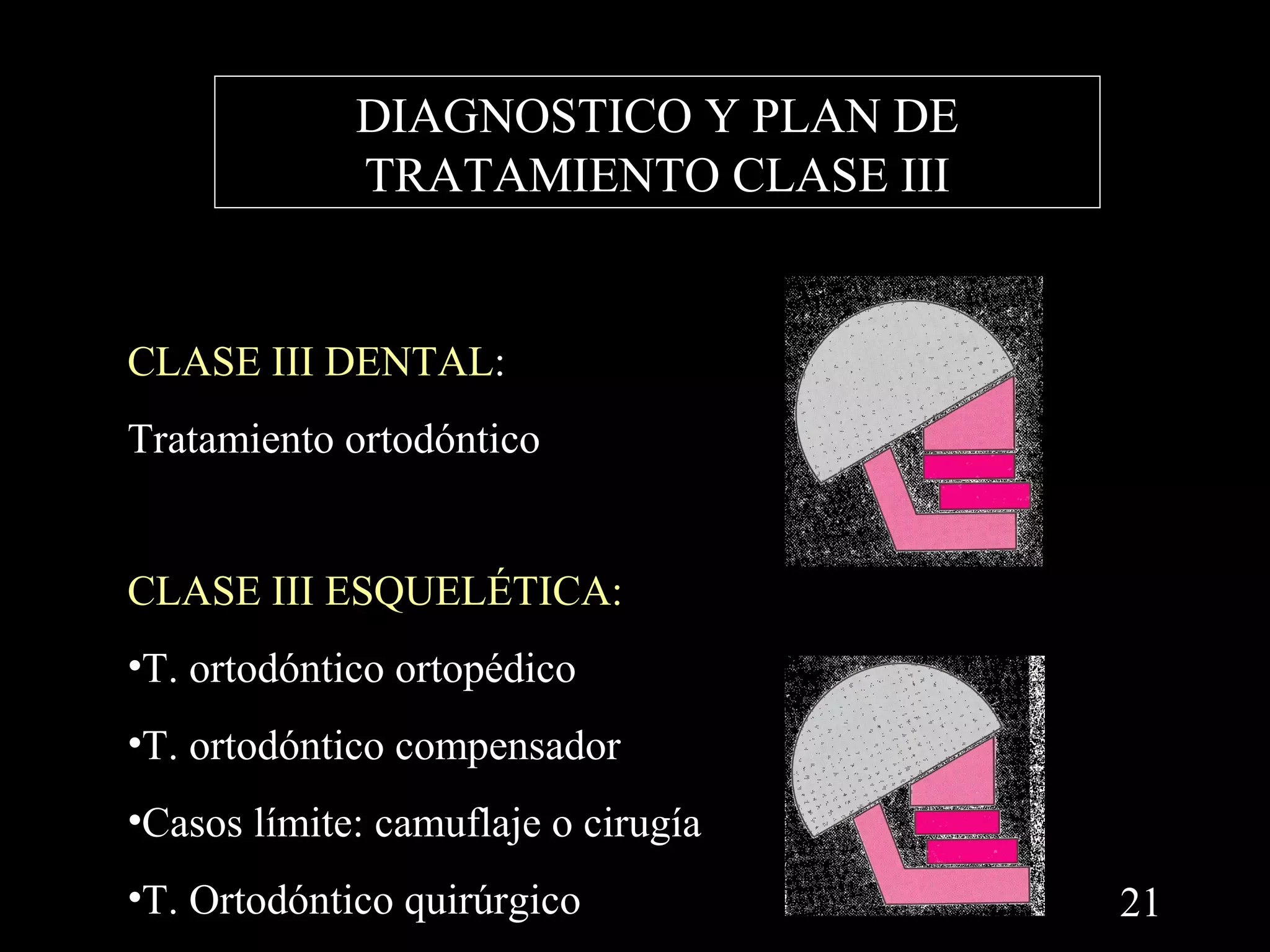 Maloclusiones clase iii | ODP