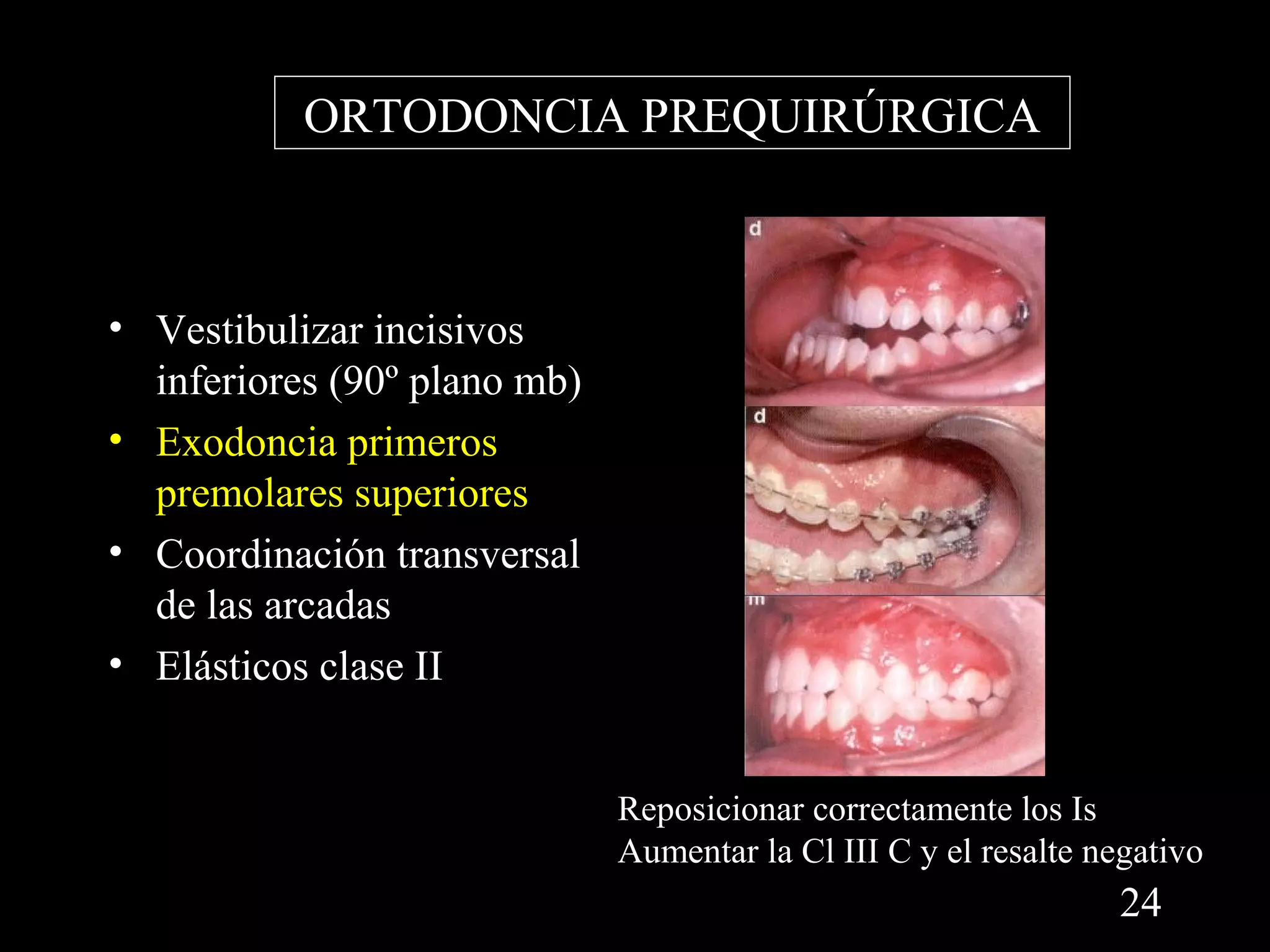 Maloclusiones clase iii | ODP