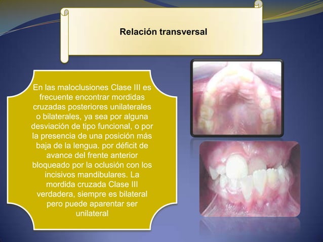 Maloclusiones de clase_iii | PPTX