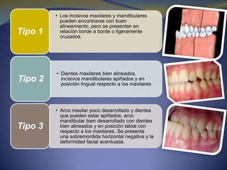 Maloclusiones de clase_iii | PPTX
