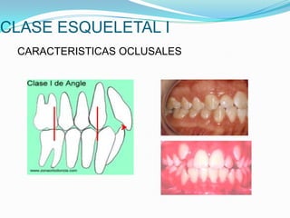 Maloclusiones esqueletales 8 vo | PPTX