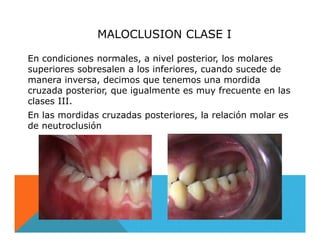 Maloclusion,Tipos y Clasificación | PDF