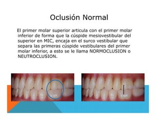 Maloclusion,Tipos y Clasificación | PDF