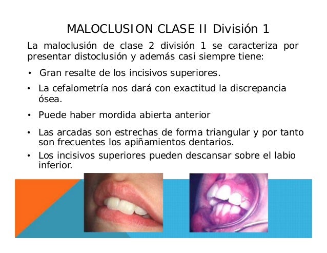 Maloclusion,Tipos y Clasificación
