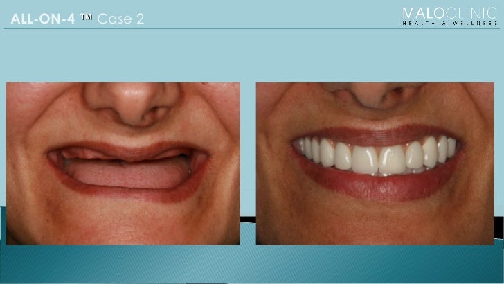 Edentulism & Revolutionary Treatment :- The "All-on-4" Dental Implant…