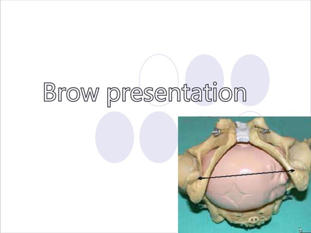 Malposition and malpresentations | PPTX | Pregnancy | Reproductive Health