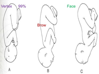 Malposition and malpresentations | PPTX