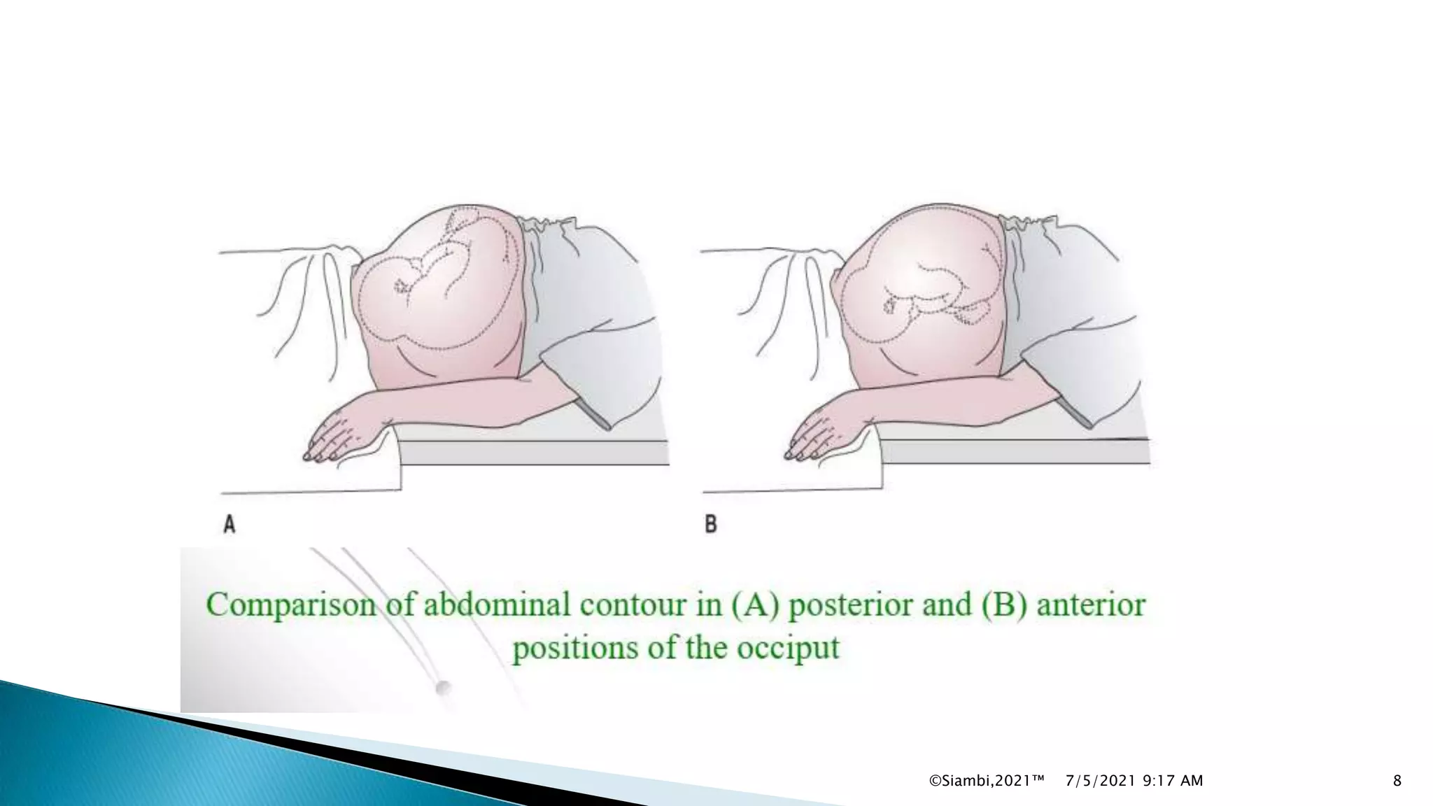 Malposition -Reproductive Health Lecture Notes | PPT