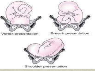 MALPOSITIONS during childbirth .ppt