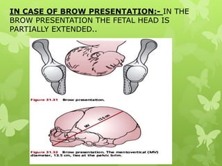 MAL POSITIONS & MAL PRSENTATIONS | PPT