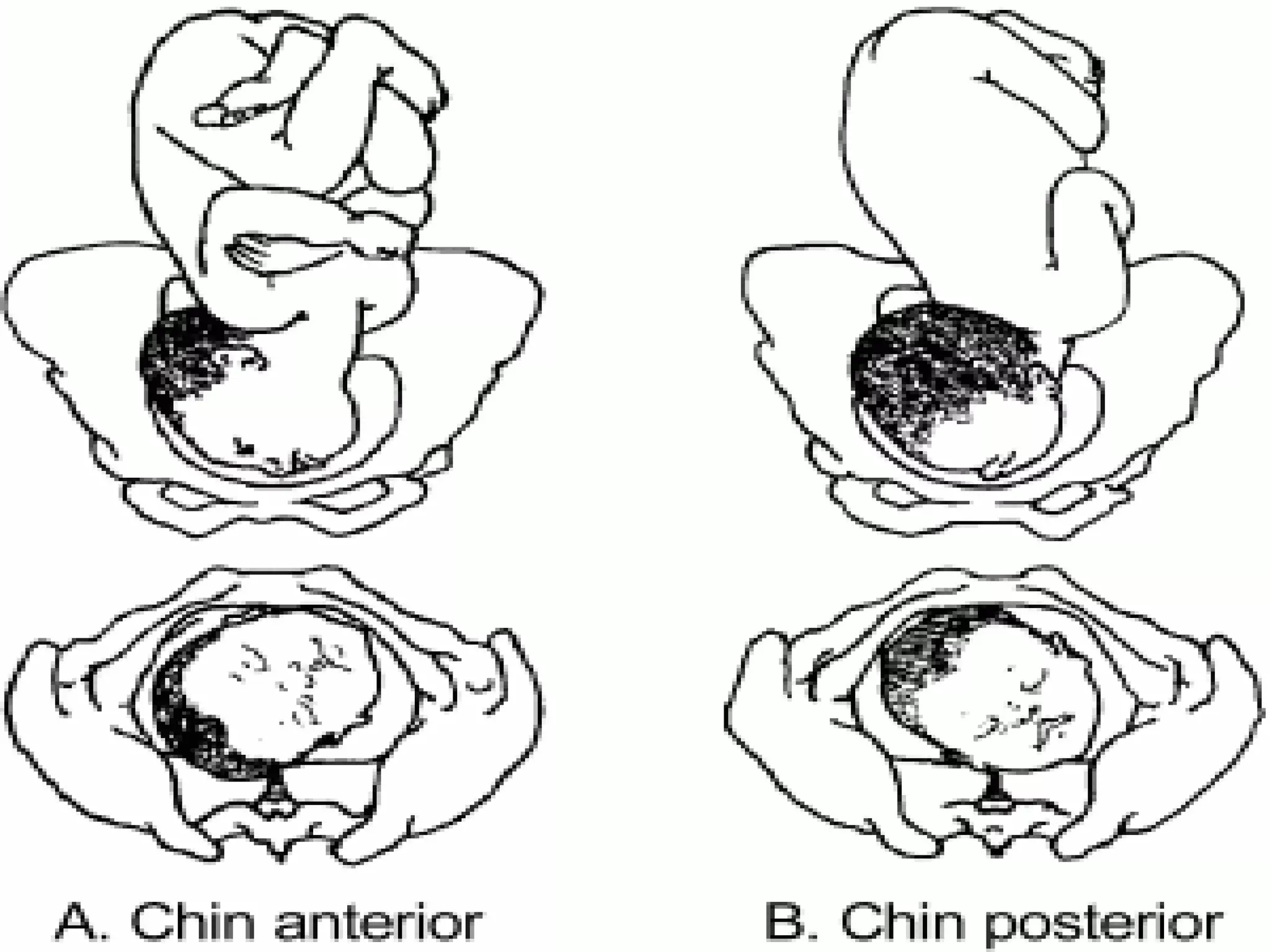 Malpresentasi dan malposisi | PPT