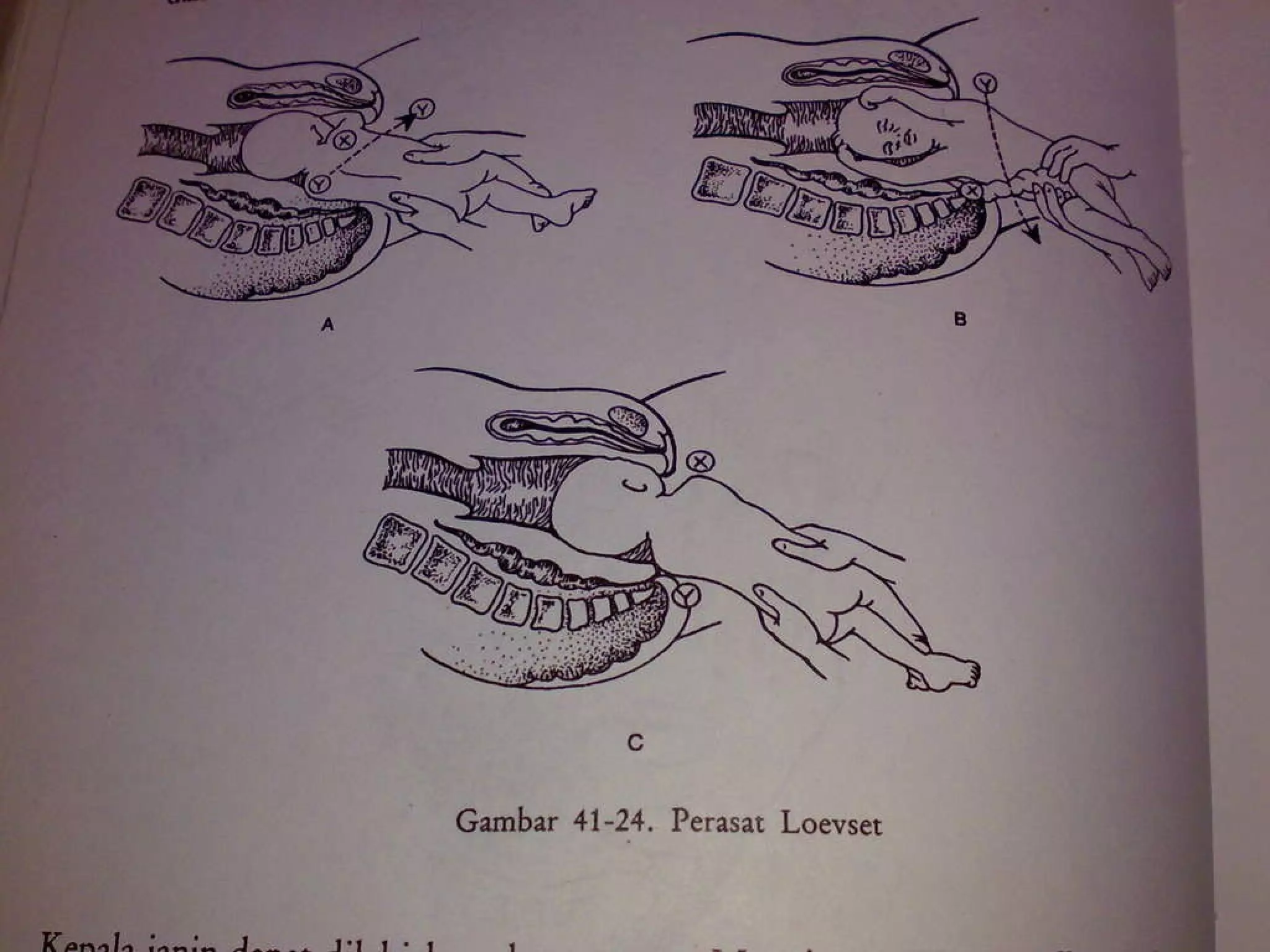 Malpresentasi dan malposisi | PPT