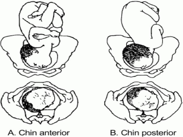Malpresentasi dan malposisi | PPT