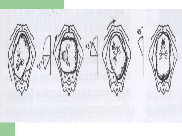 Malpresentasi dan malposisi | PPT