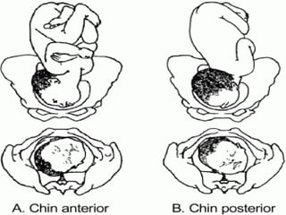 Malpresentasi dan malposisi | PPT